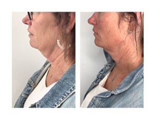 FAT DISSOLVE CASE STUDY - Aescend Aesthetics