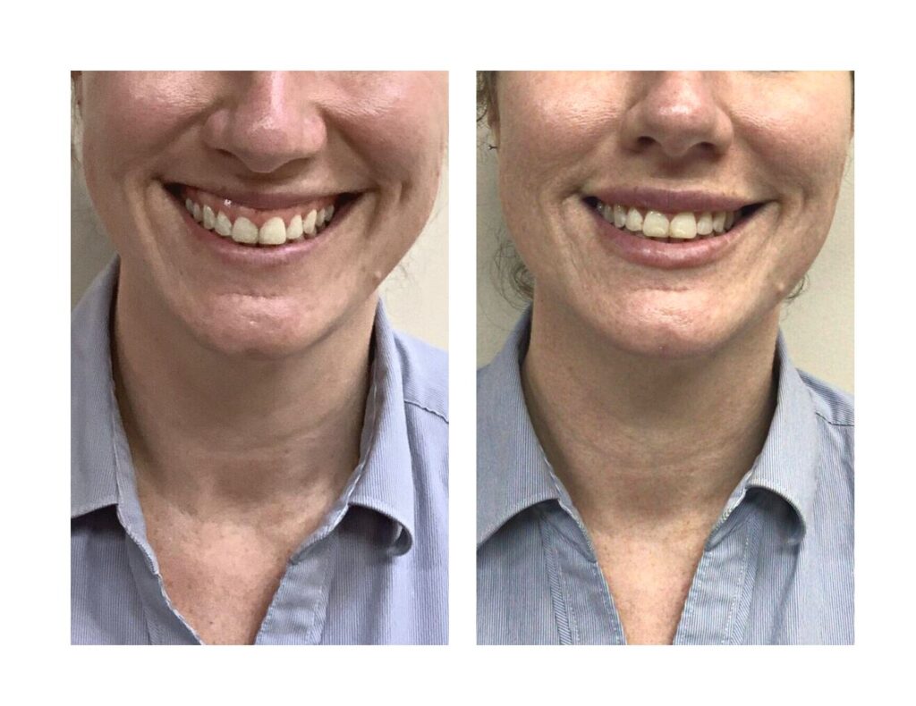 LIP AND SMILE ENHANCEMENT - 'Gummy Smile' CASE STUDY
