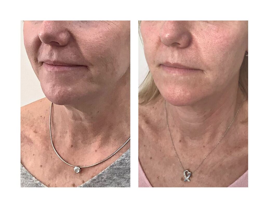 NECK REJUVENATION CASE STUDY - Aescend Aesthetics
